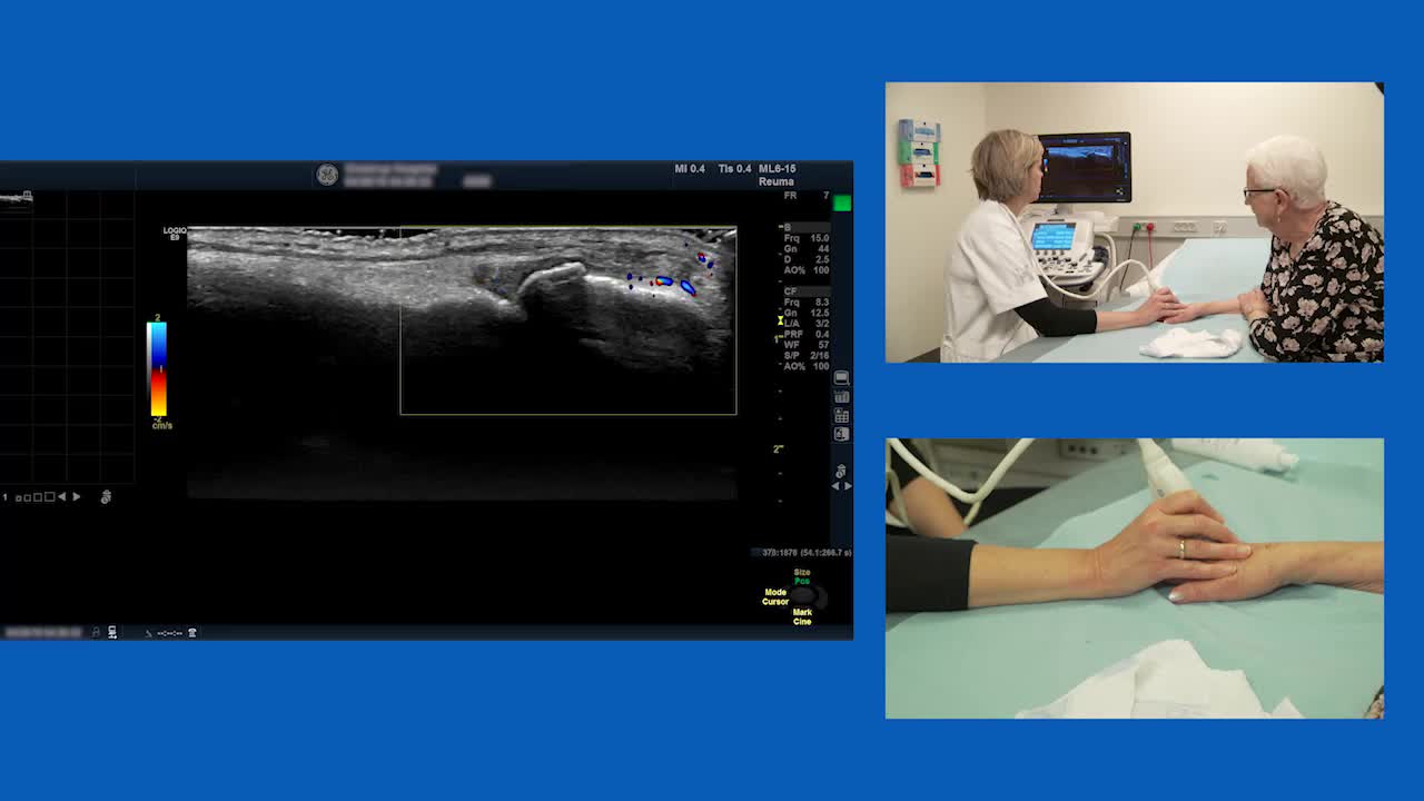 POCUS MSK Course Video | Live Demo Of Quantitative Scoring